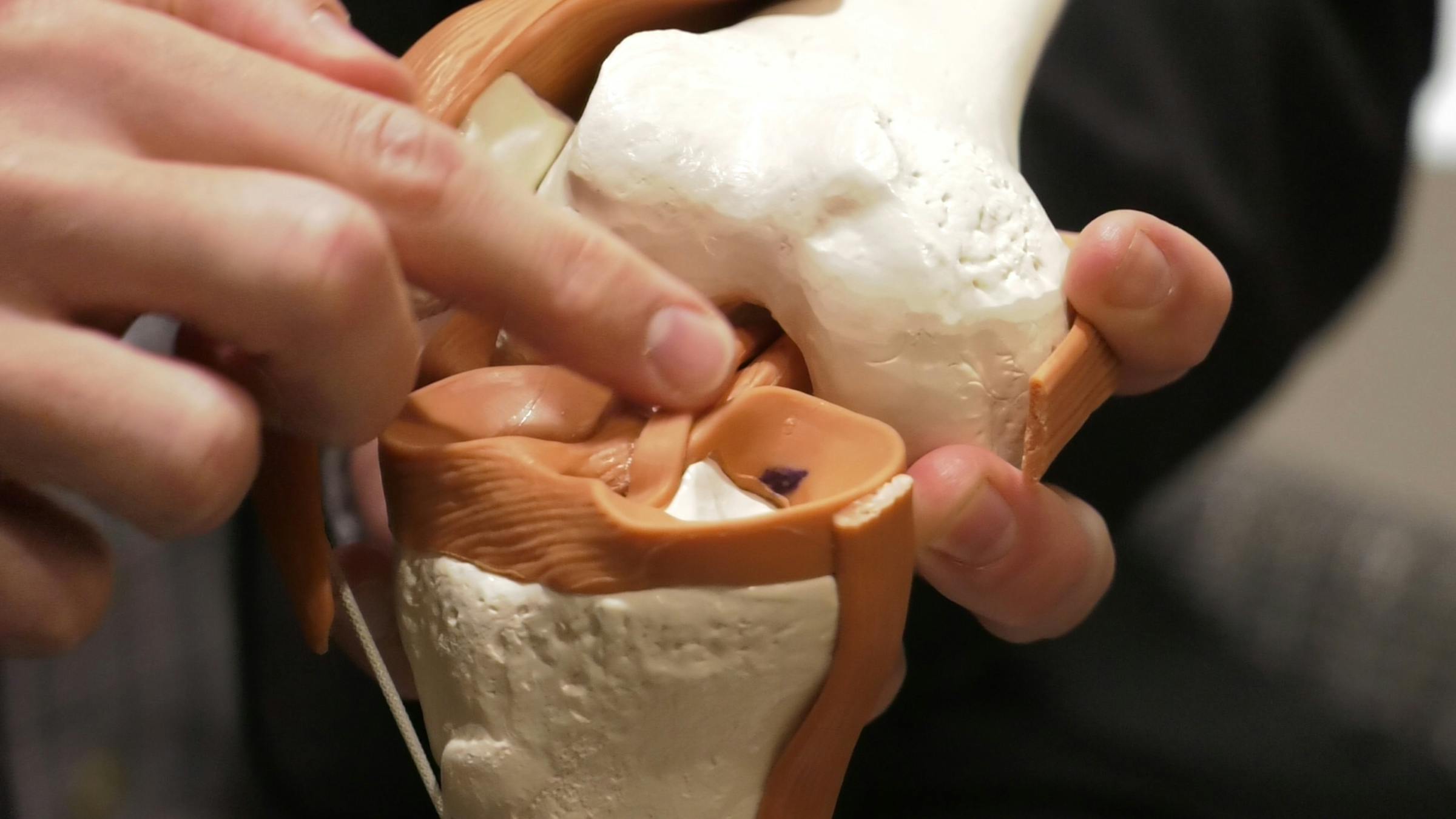 NFL players with ACL injuries face uncertain recovery, shortened careers